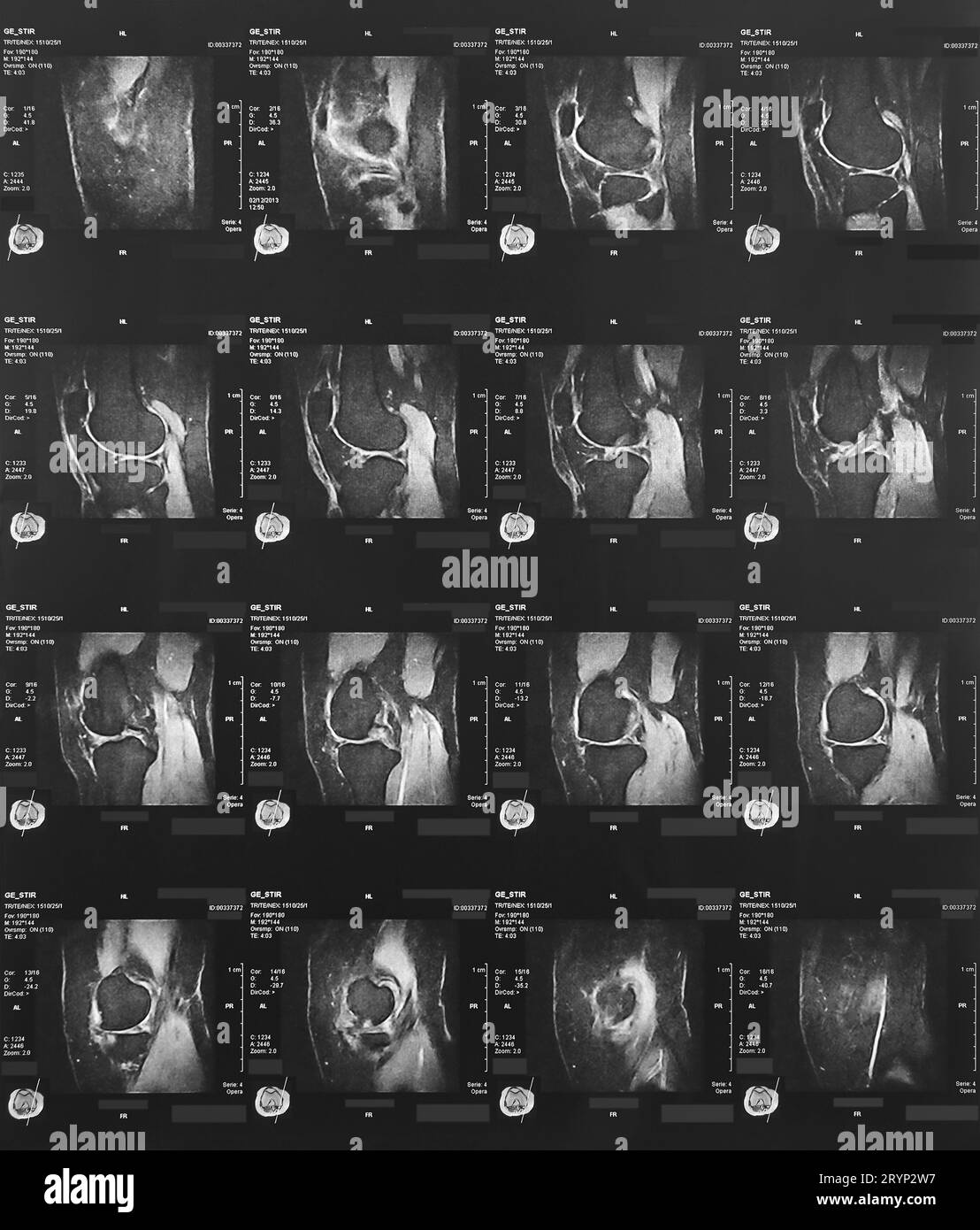 Magnetic Resonance Therapy For Knee Osteoarthritis at Sean Freeleagus blog