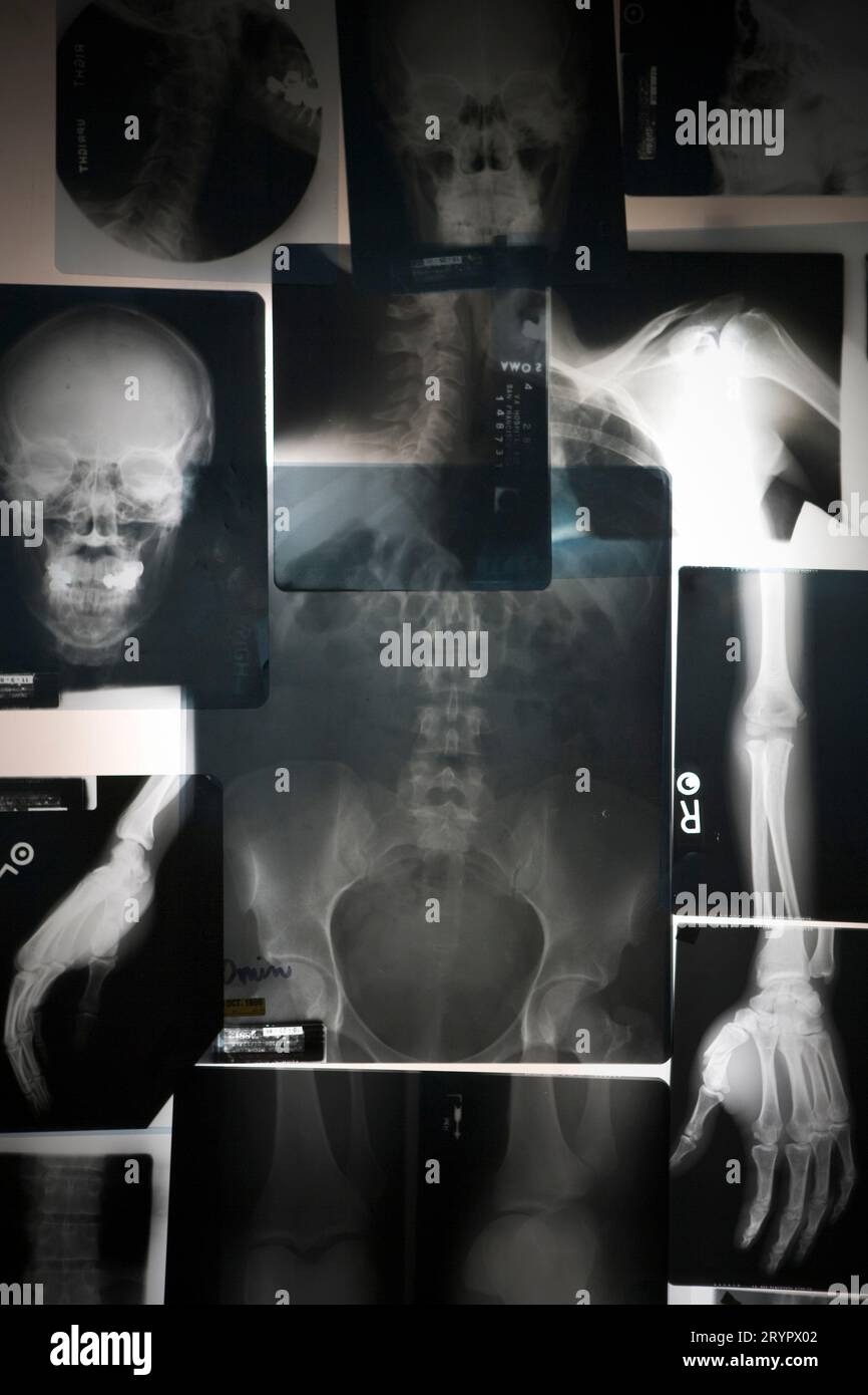 A collage of x-rays form a human skeleton Stock Photo - Alamy