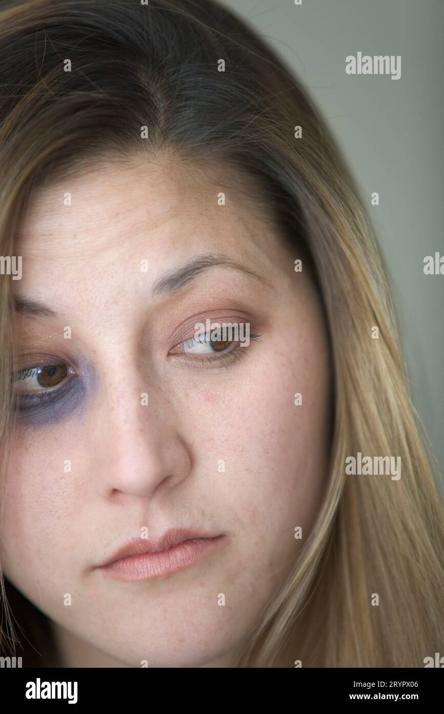 Black bruised eye hi-res stock photography and images - Alamy