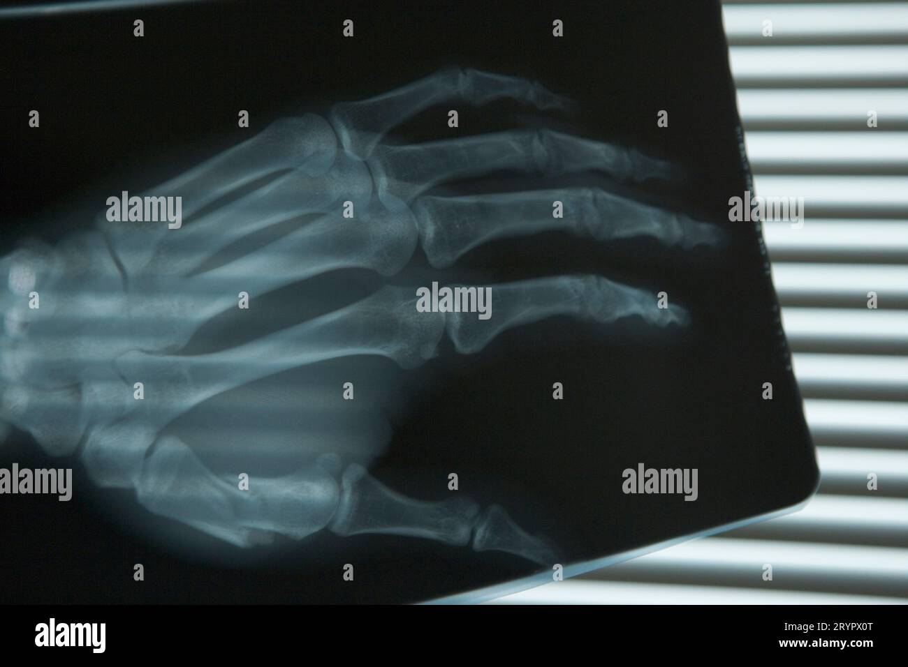 X-ray of a human hand Stock Photo - Alamy