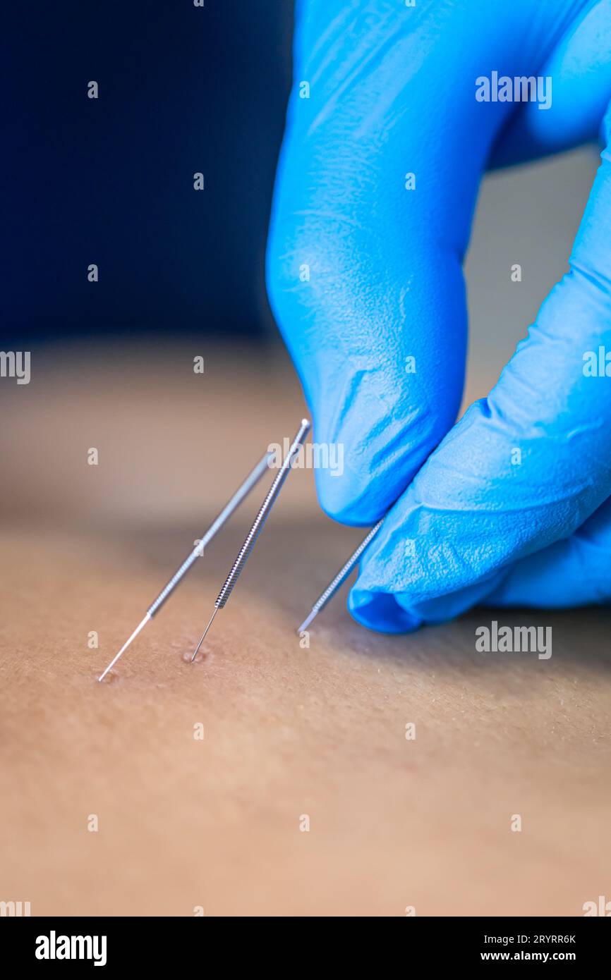 Physio dry needling hi-res stock photography and images - Alamy