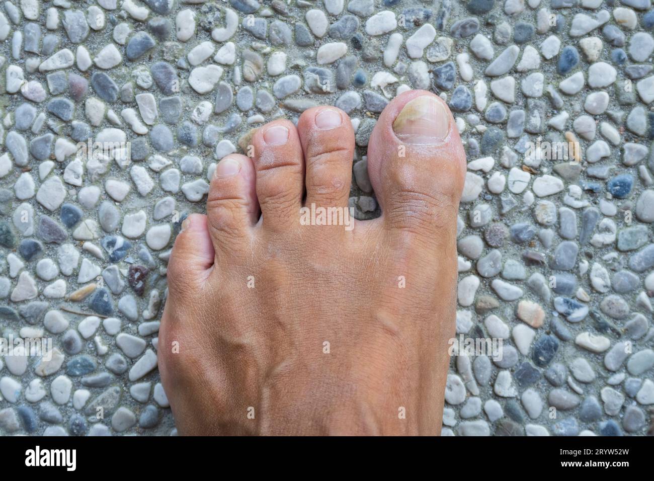 Toenails with fungus problems,Onychomycosis, also known as tinea ...