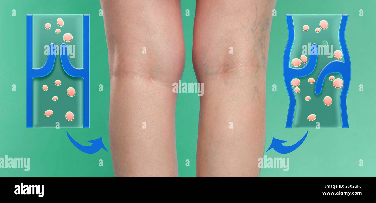 Varicose veins. Woman showing legs on turquoise background, closeup ...