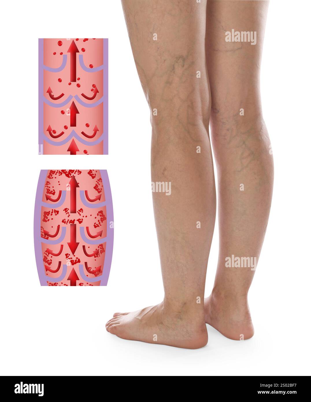 Varicose veins. Woman showing legs on white background, closeup ...