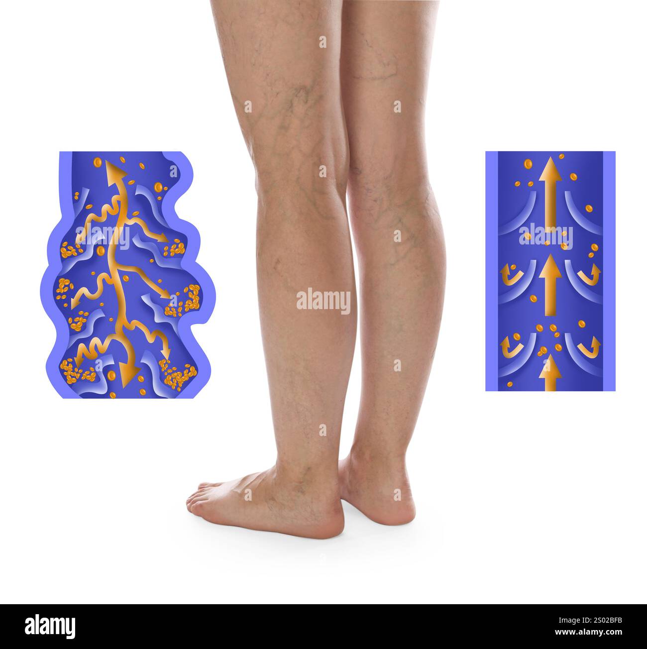 Varicose veins. Woman showing legs on white background, closeup ...