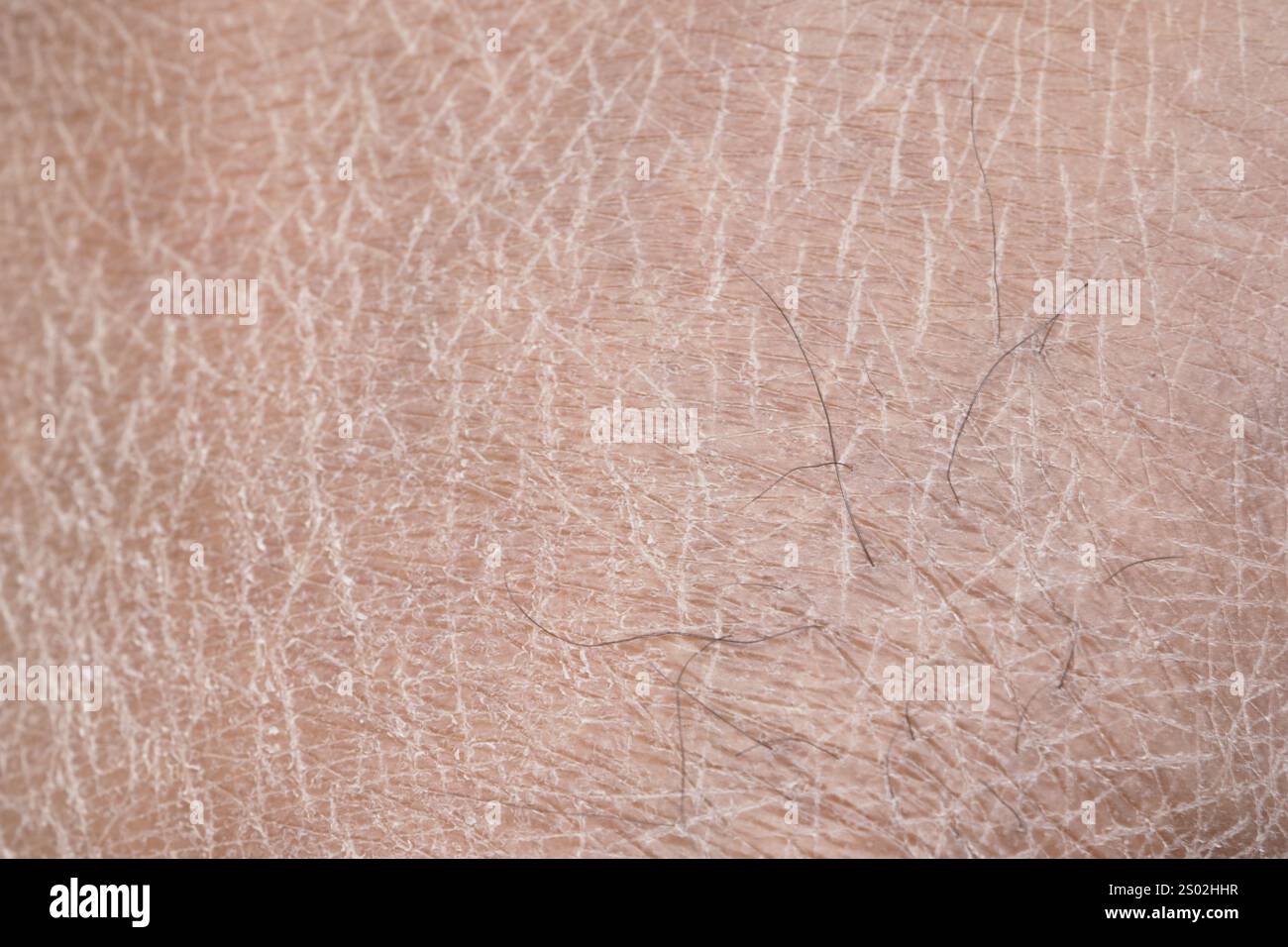Closeup view of dry human skin Stock Photo - Alamy