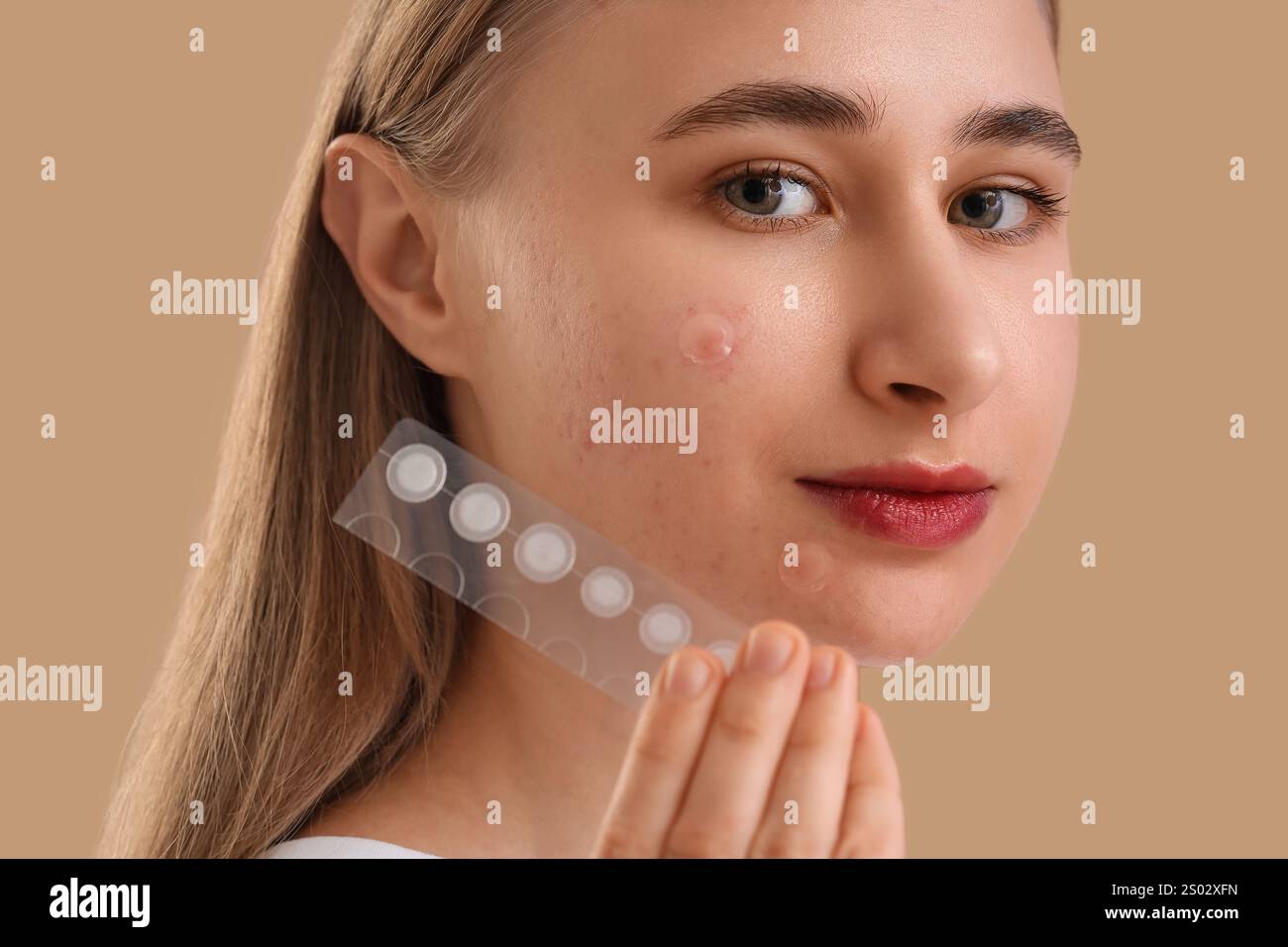 Young woman with acne problem and pimple patches on beige background ...