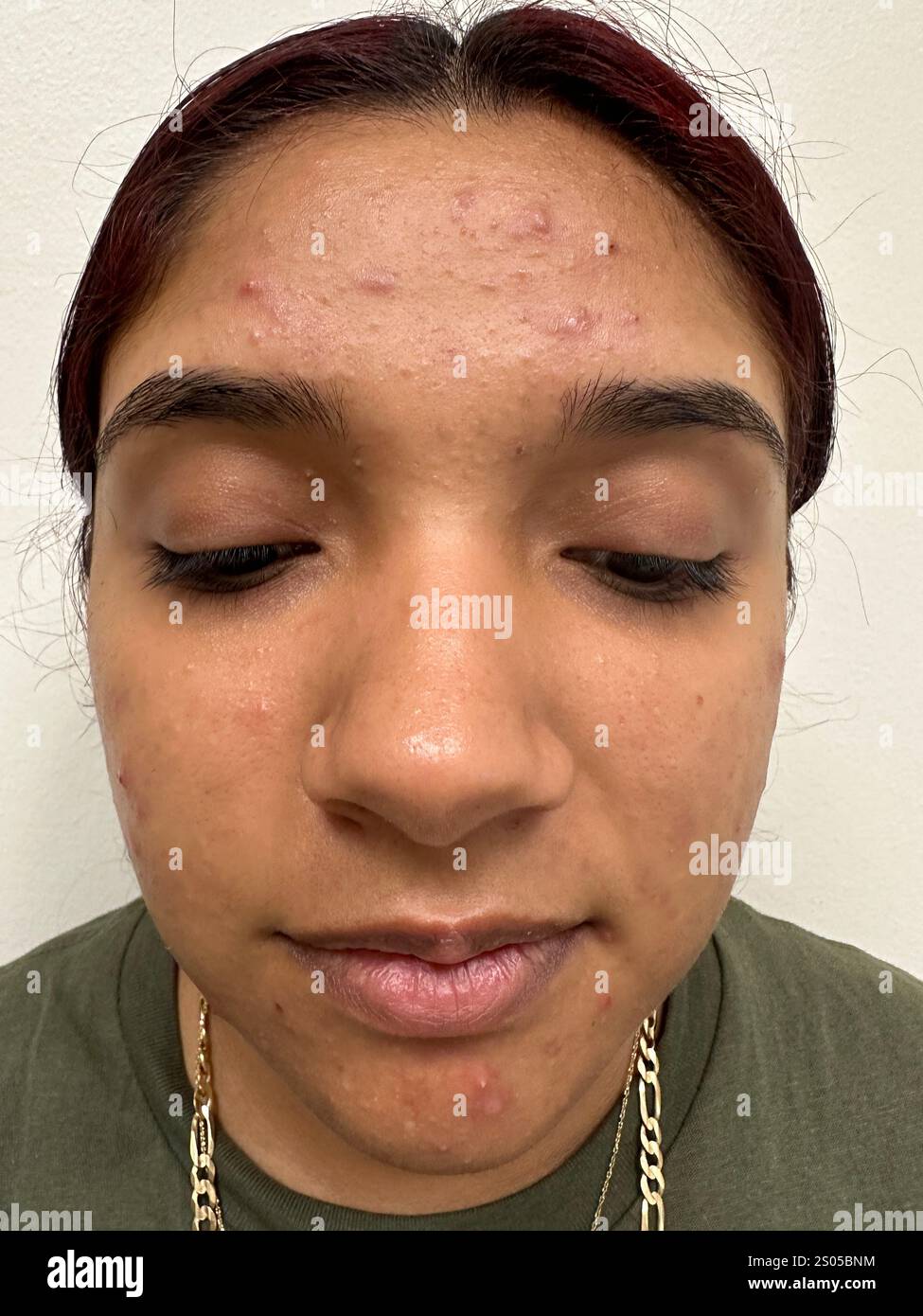 Editorial use only Acne on a patient's face. Acne is a general name ...