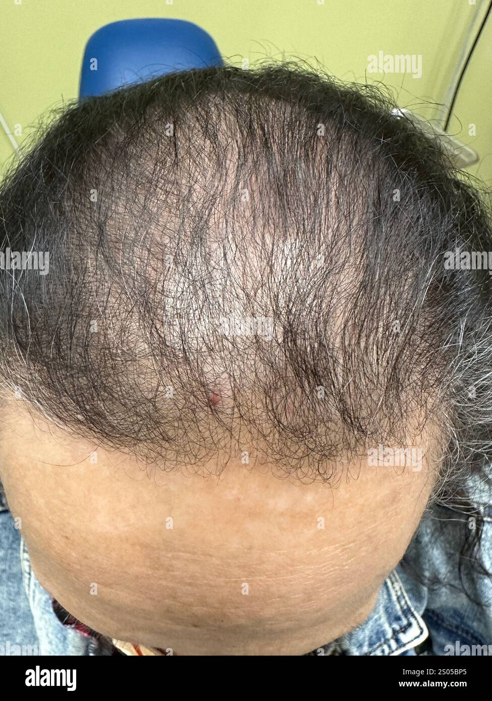 Scalp of a Hispanic patient with female pattern hair loss, also known ...