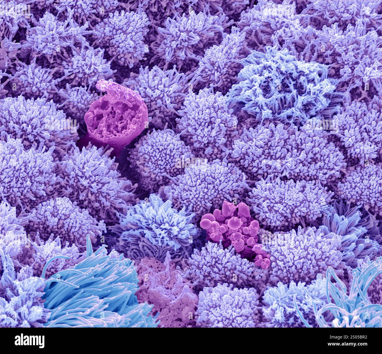 Chronic rhinosinusitis (CRS). Coloured scanning electron micrograph ...