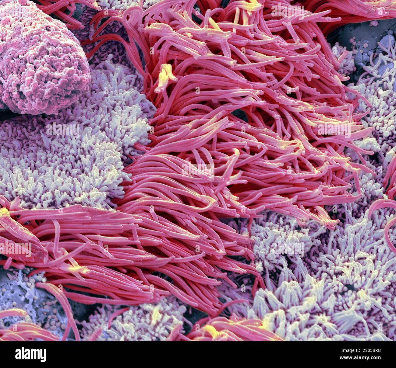 Chronic rhinosinusitis (CRS). Coloured scanning electron micrograph ...