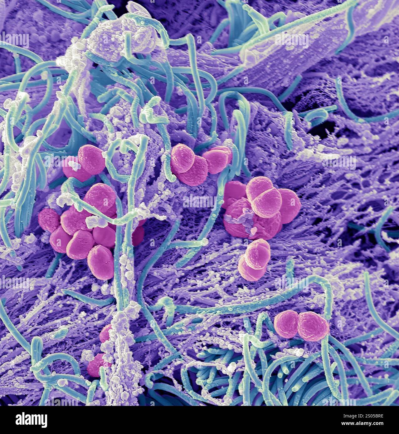 Chronic rhinosinusitis with polyps, SEM Stock Photo - Alamy