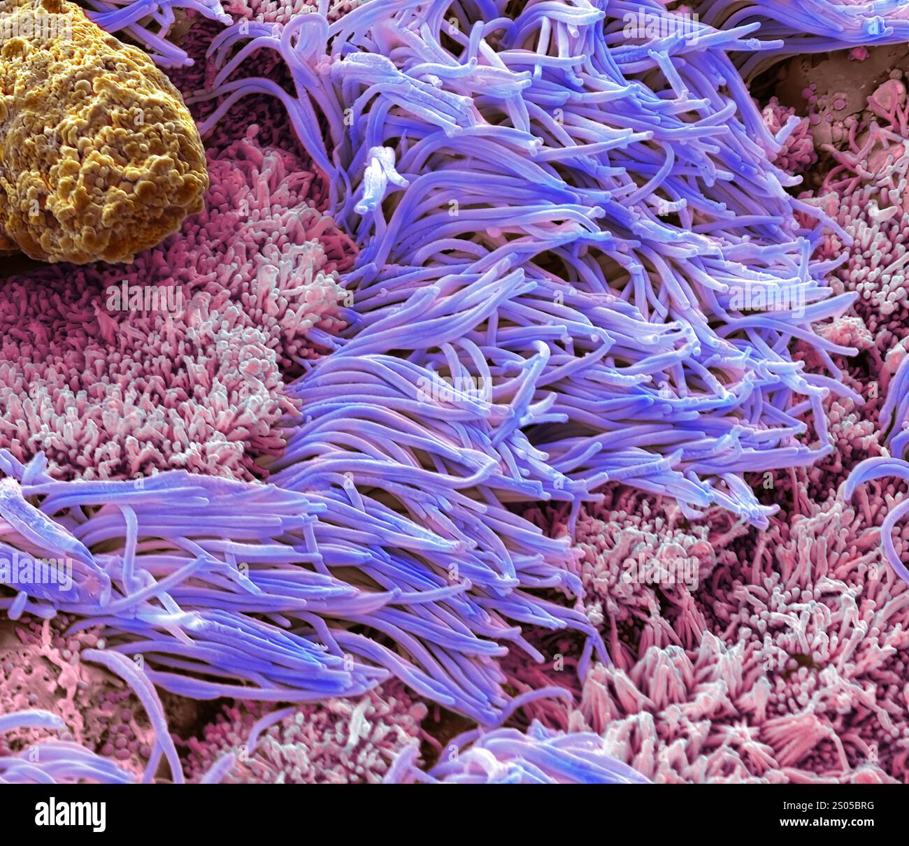 Chronic rhinosinusitis (CRS). Coloured scanning electron micrograph ...