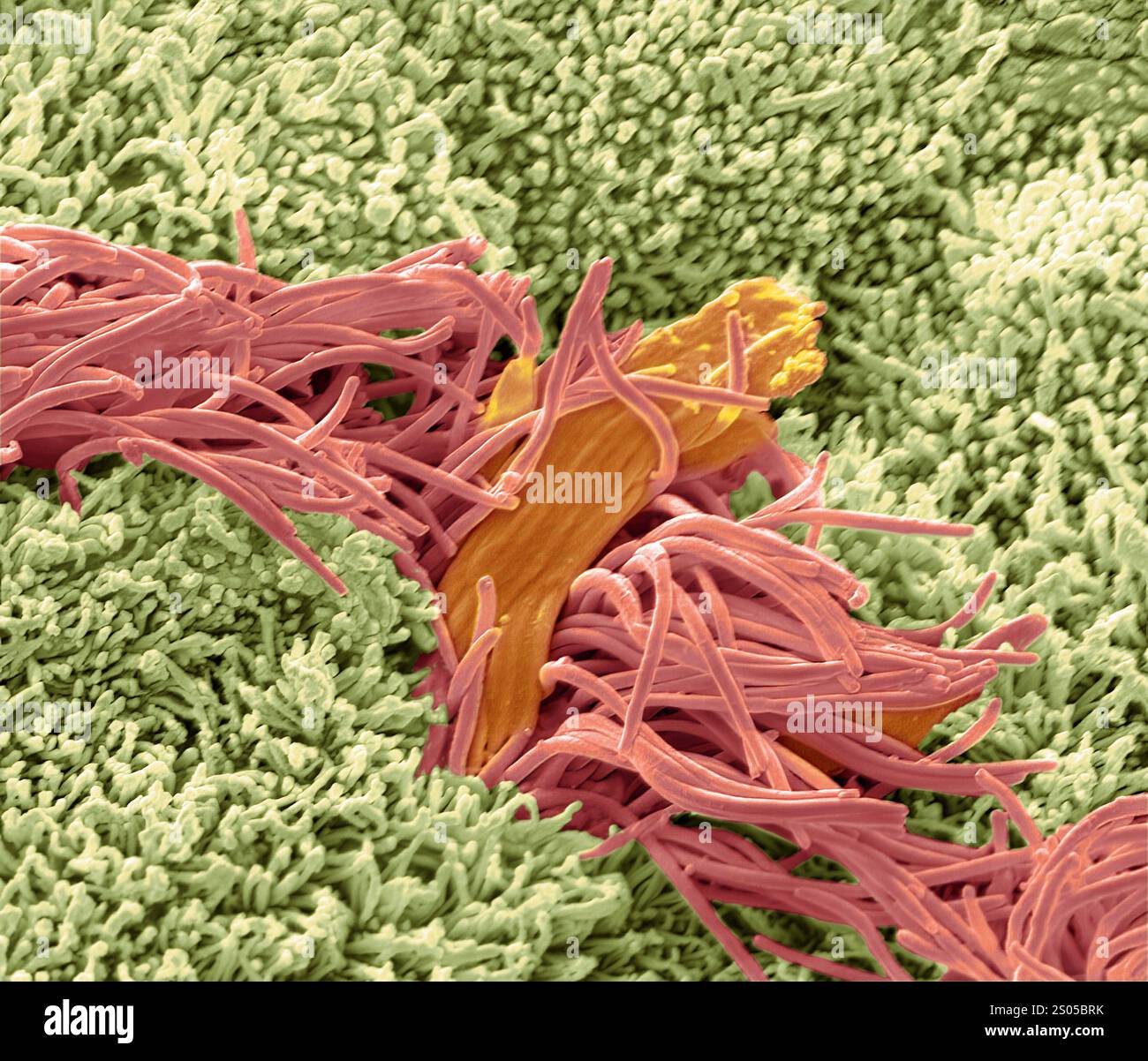 Chronic rhinosinusitis (CRS). Coloured scanning electron micrograph ...