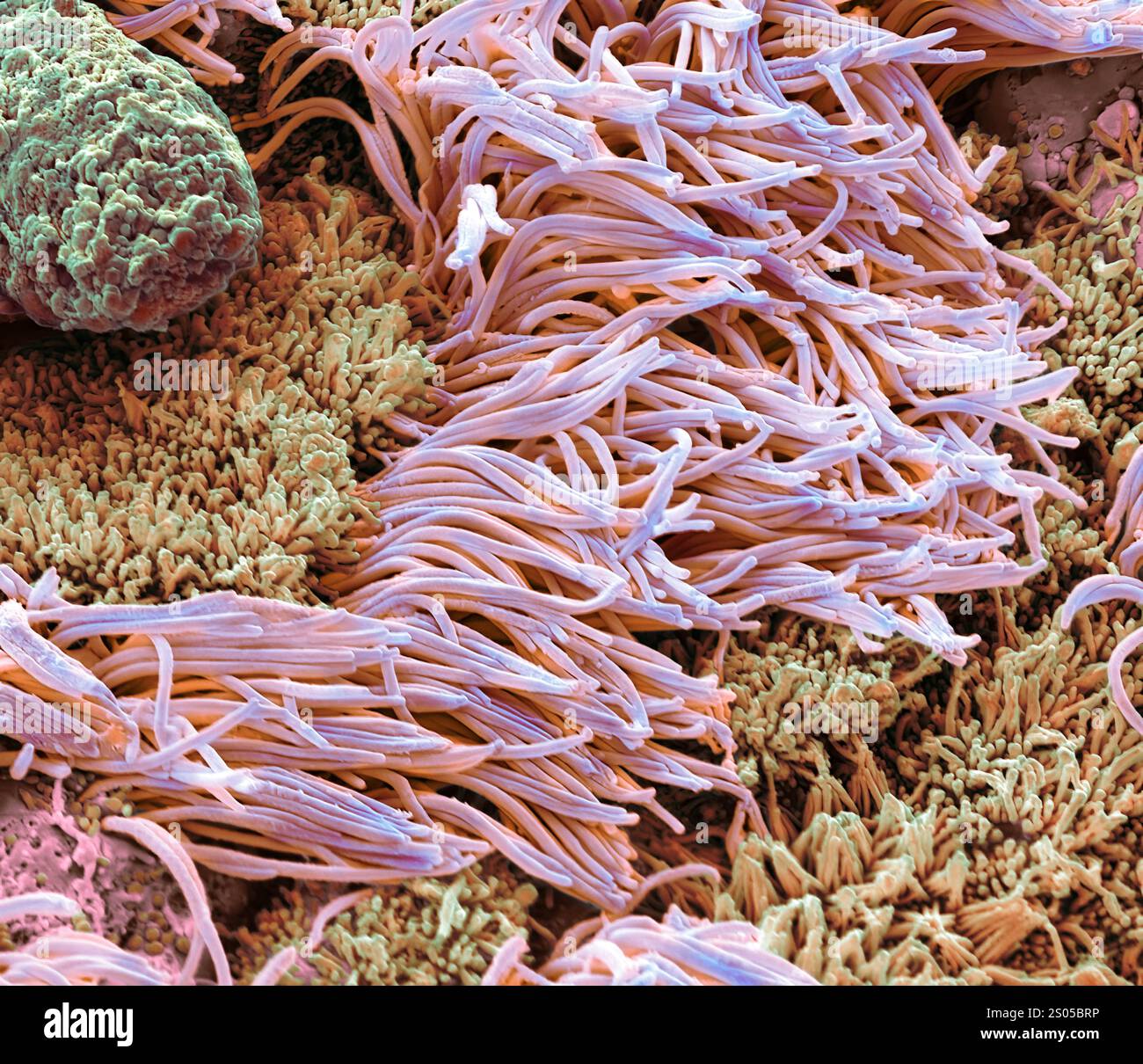 Chronic rhinosinusitis (CRS). Coloured scanning electron micrograph ...