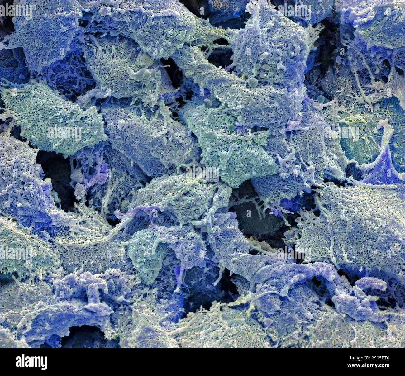 Chronic rhinosinusitis (CRS). Coloured scanning electron micrograph ...