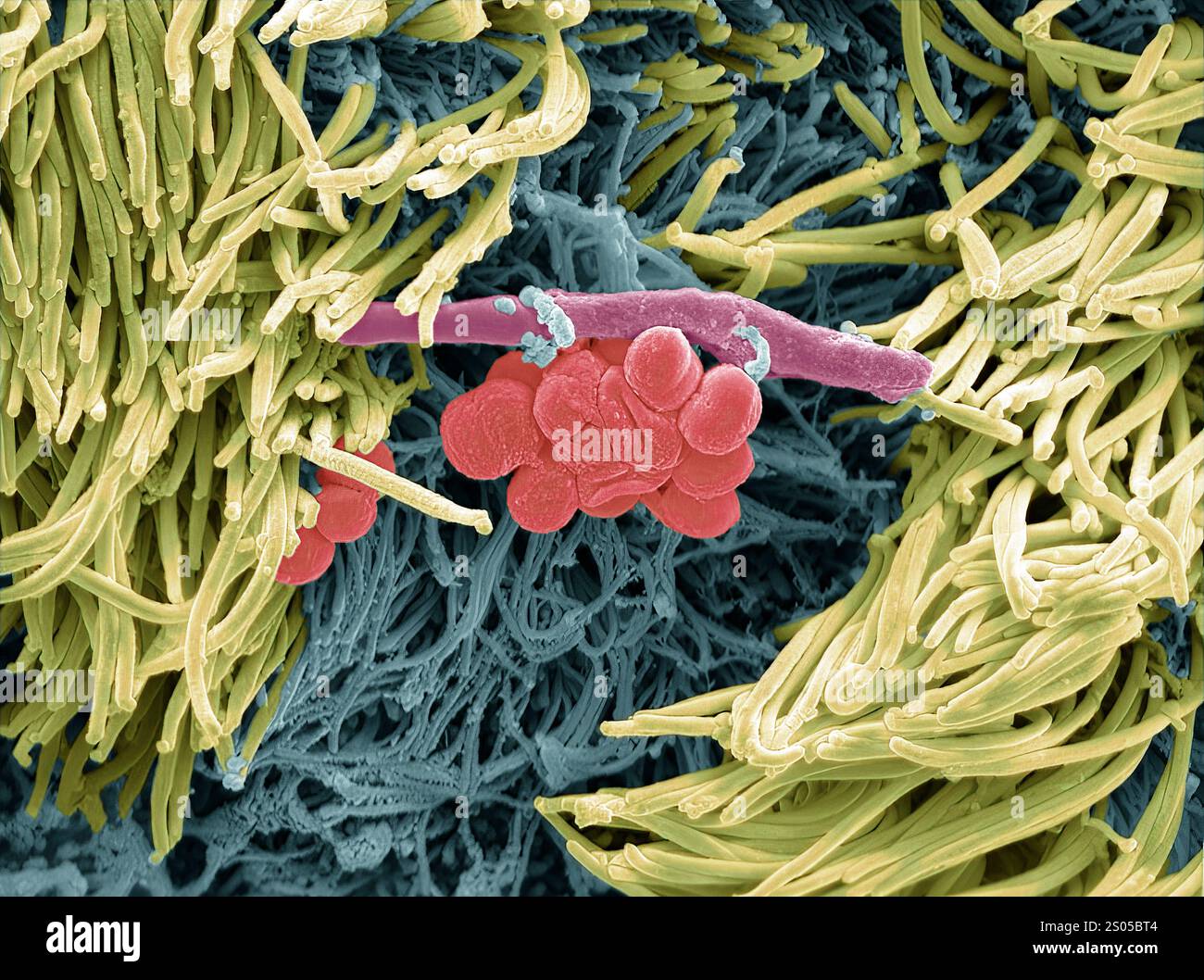 Chronic rhinosinusitis (CRS). Coloured scanning electron micrograph ...