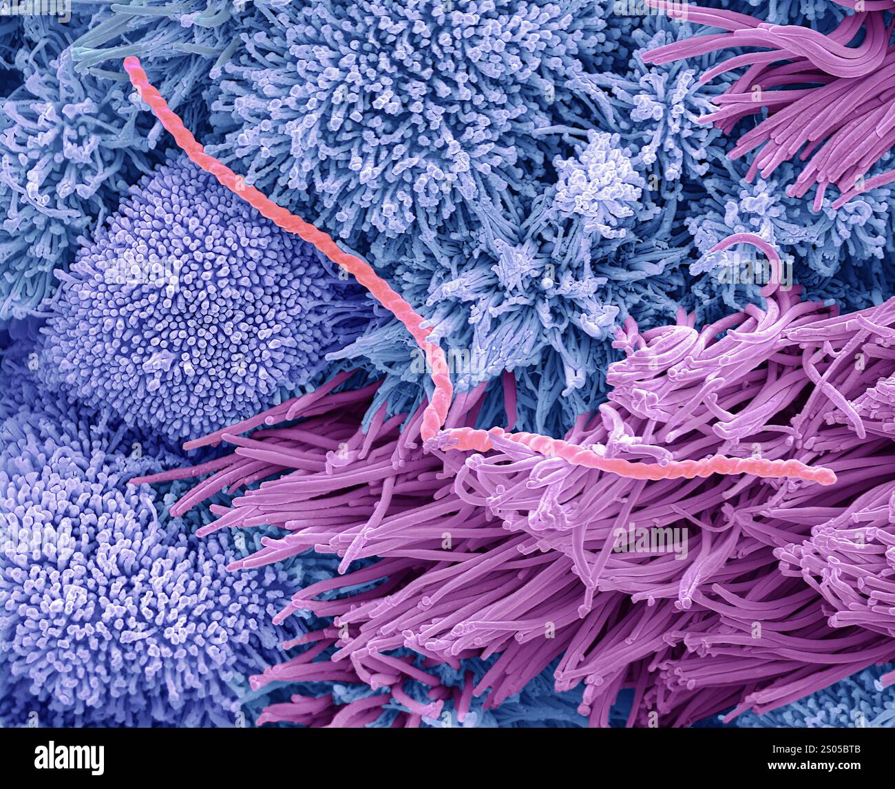 Chronic rhinosinusitis (CRS). Coloured scanning electron micrograph ...