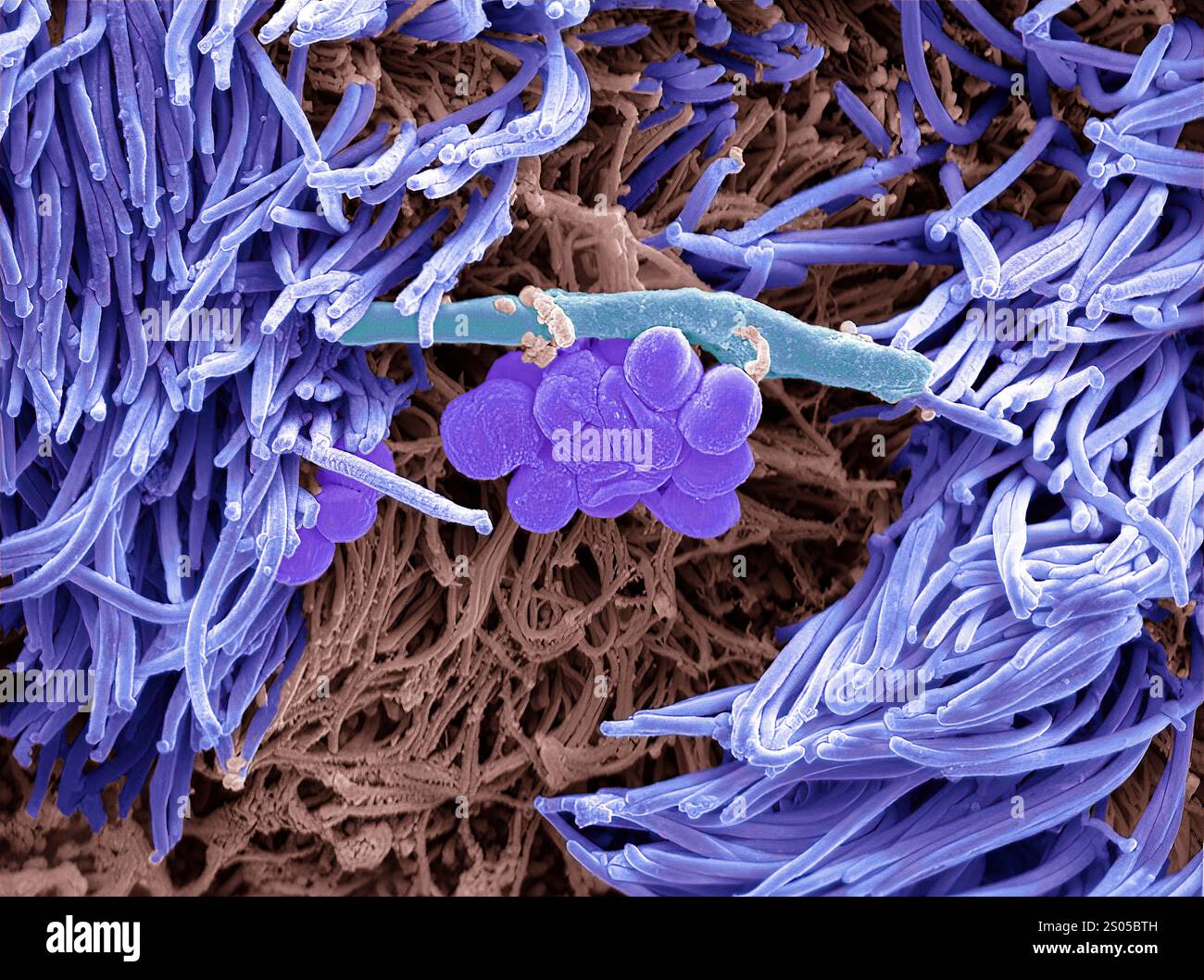 Chronic rhinosinusitis (CRS). Coloured scanning electron micrograph ...