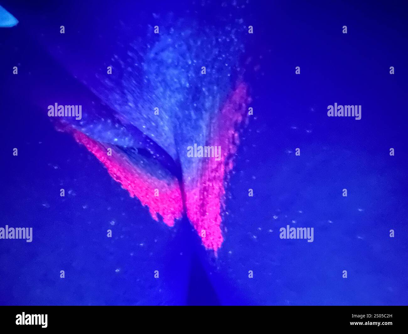 Erythrasma at the top of a man's thigh viewed under ultraviolet (UV ...
