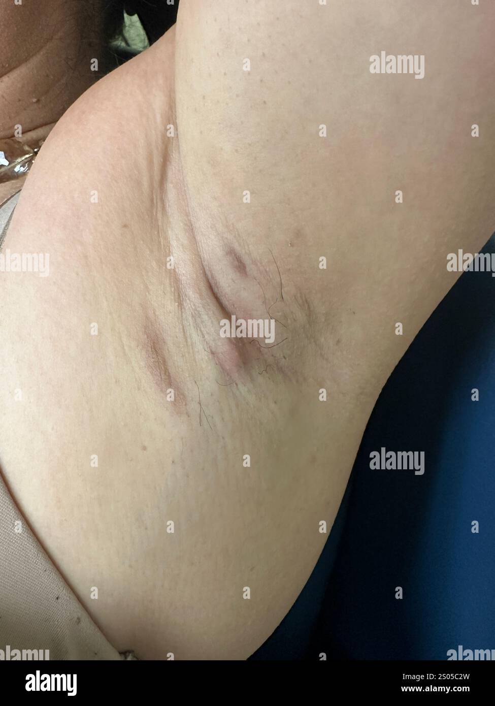 Lesions in the armpit of a Hispanic female patient with hidradenitis suppurativa. Hidradenitis ...