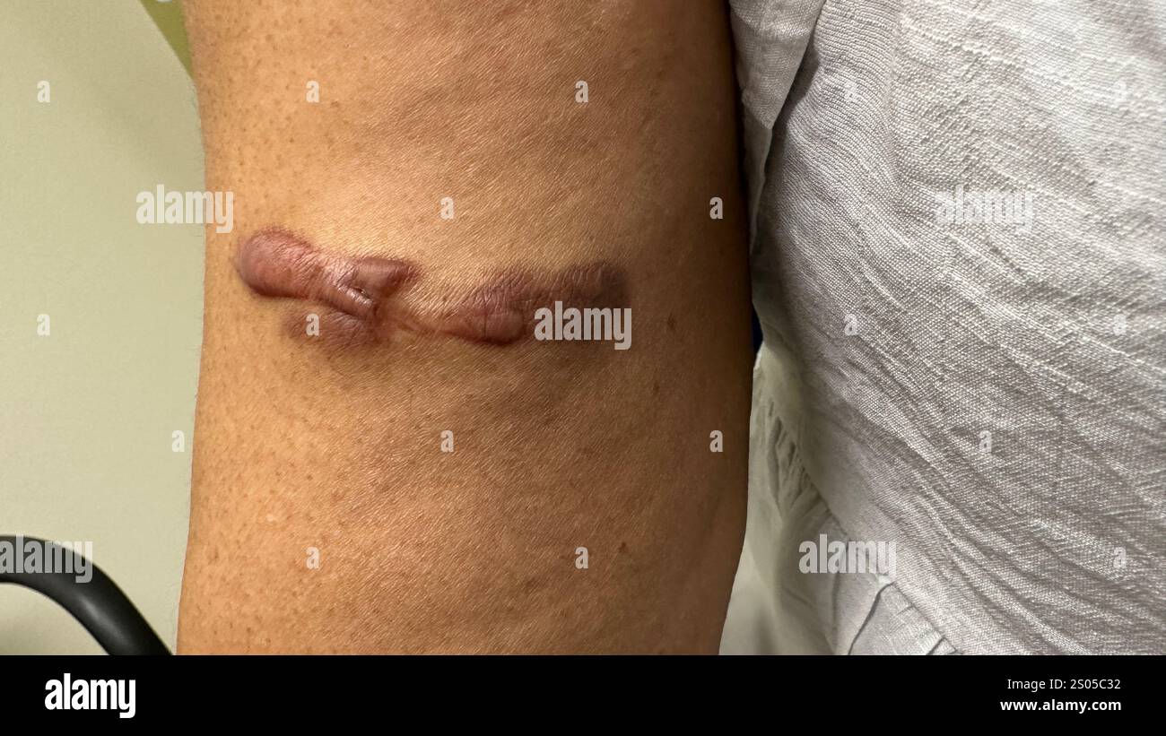 Keloid scar on a patient's arm. A keloid scar is a scar that fills with ...