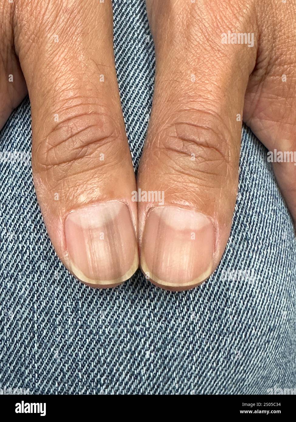 Fingernails of a patient with melanonychia. Melanonychia is a nail ...