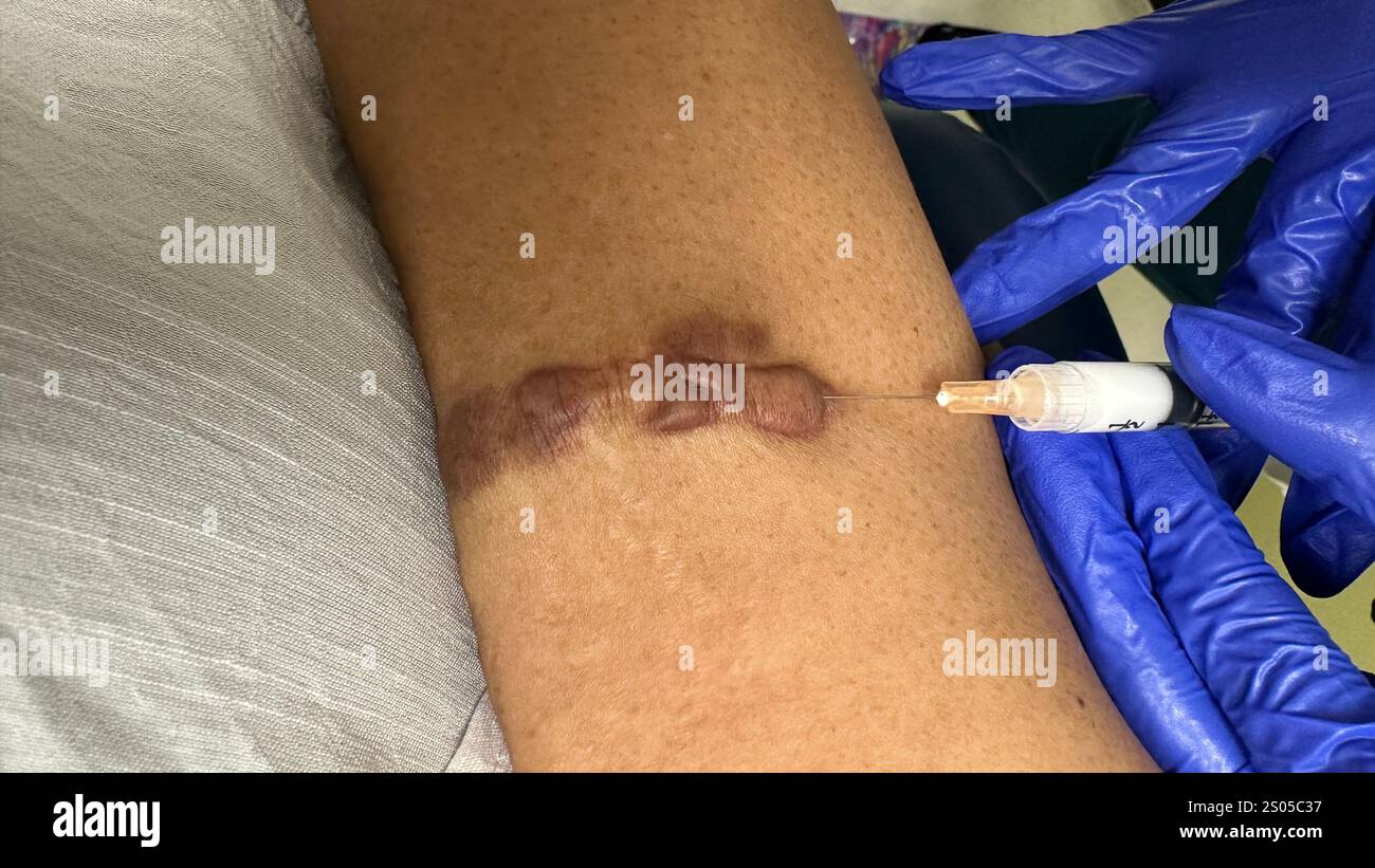 Intralesional injection of the anti-inflammatory steroid triamcinolone ...