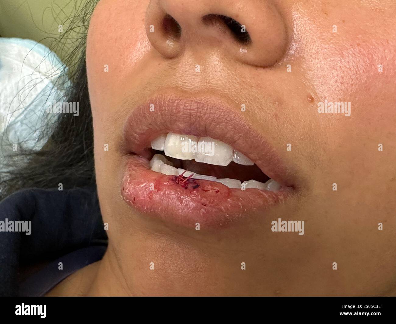 Stitches in a female patient's lip after the removal of a mucocele. A ...