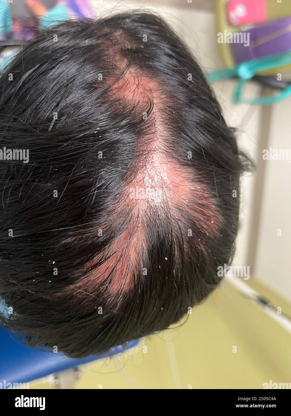 Psoriasis on a patient's scalp. Psoriasis is a skin condition where ...