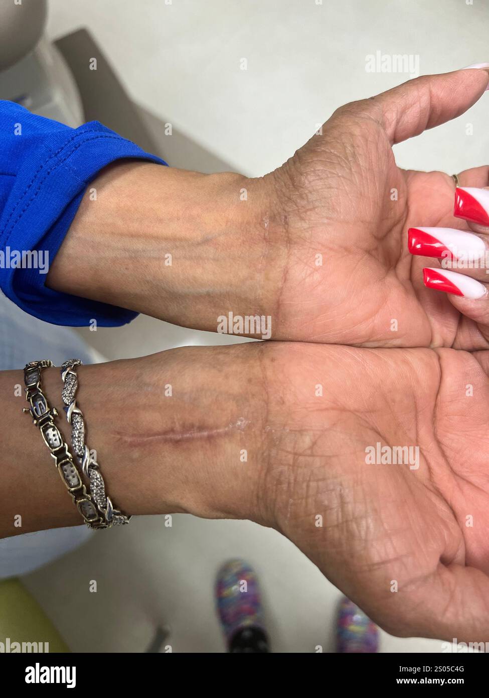 Wrists of a 61 year old Hispanic female patient infected with scabies ...