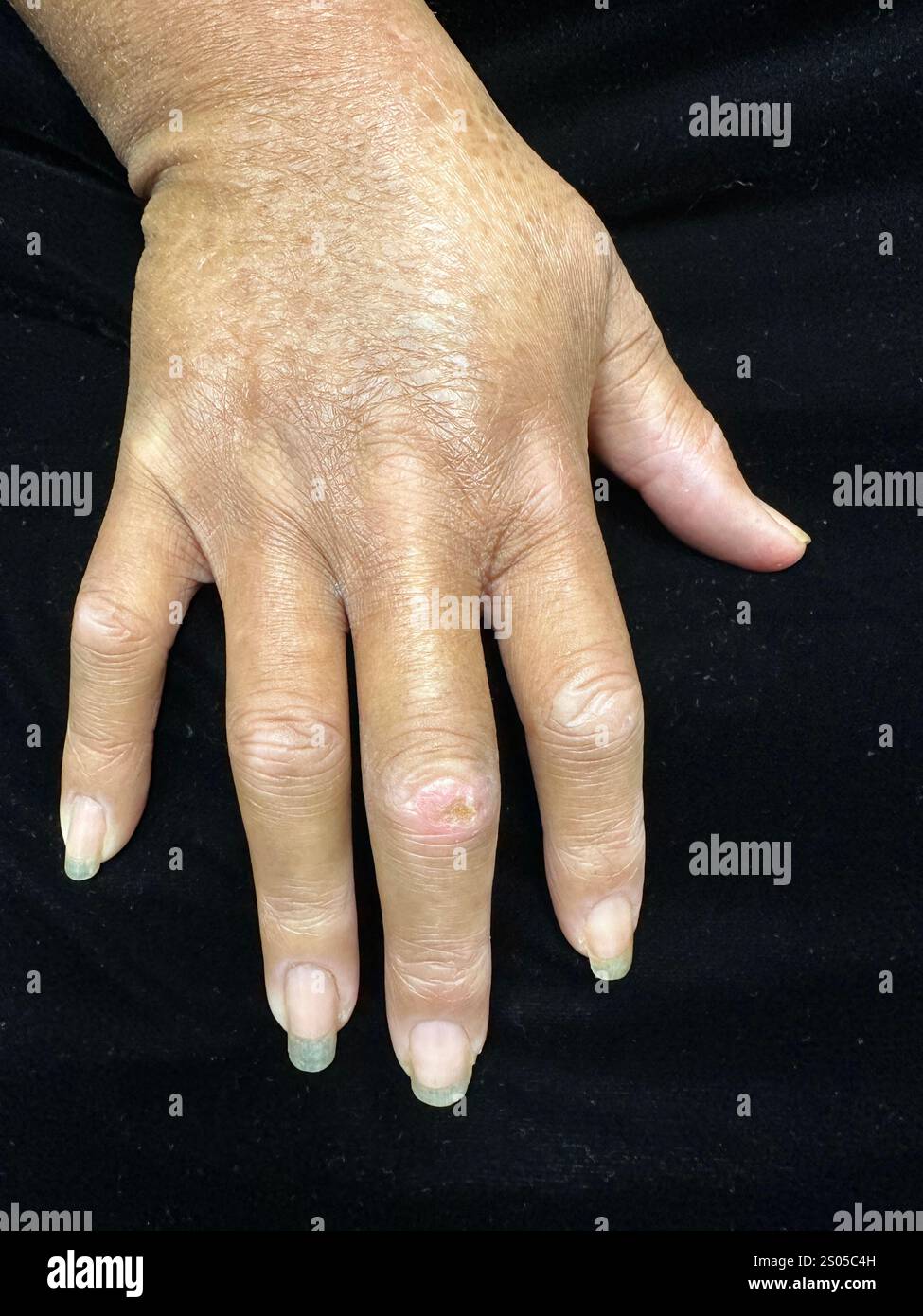 Not to be used for advertising or in a defamatory context Scleroderma ...