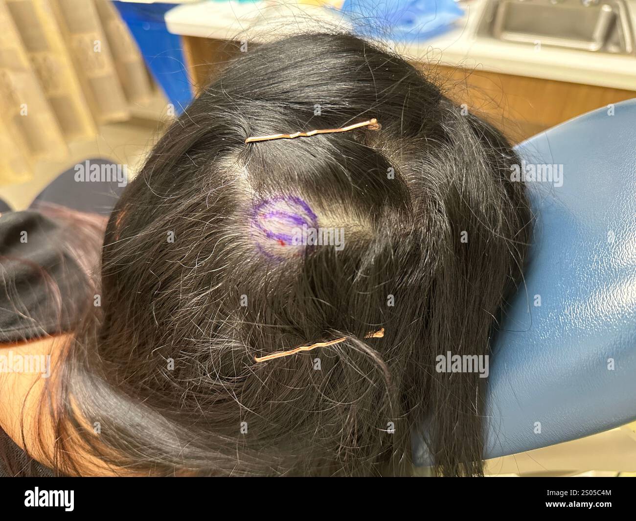 Trichilemmal cyst marked for removal on a patient's scalp. A ...