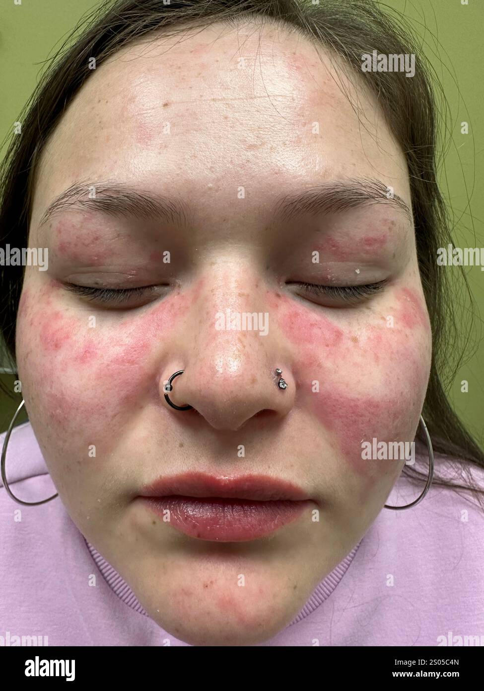 Editorial use only Redness on the face of a Hispanic female patient ...