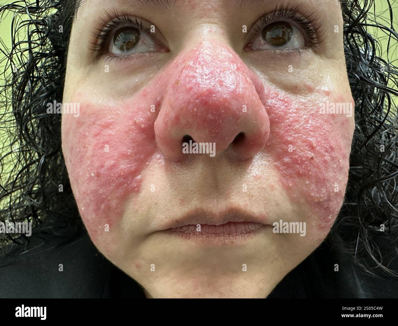 Rosacea on a 45 year old female Hispanic patient's face. Rosacea ...