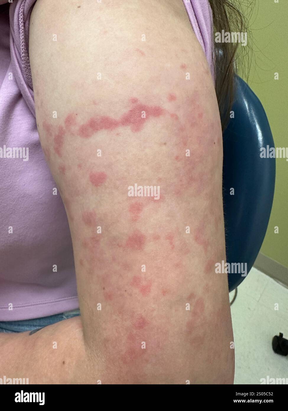 Redness on the arm of a Hispanic female patient with systemic lupus ...