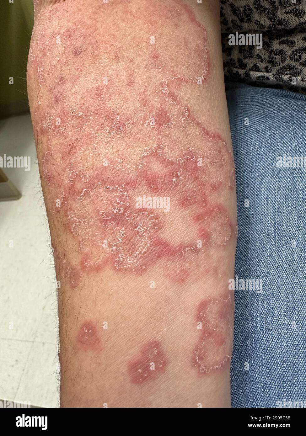 Ringworm infection on a patient's arm. Ringworm is a disease caused by ...