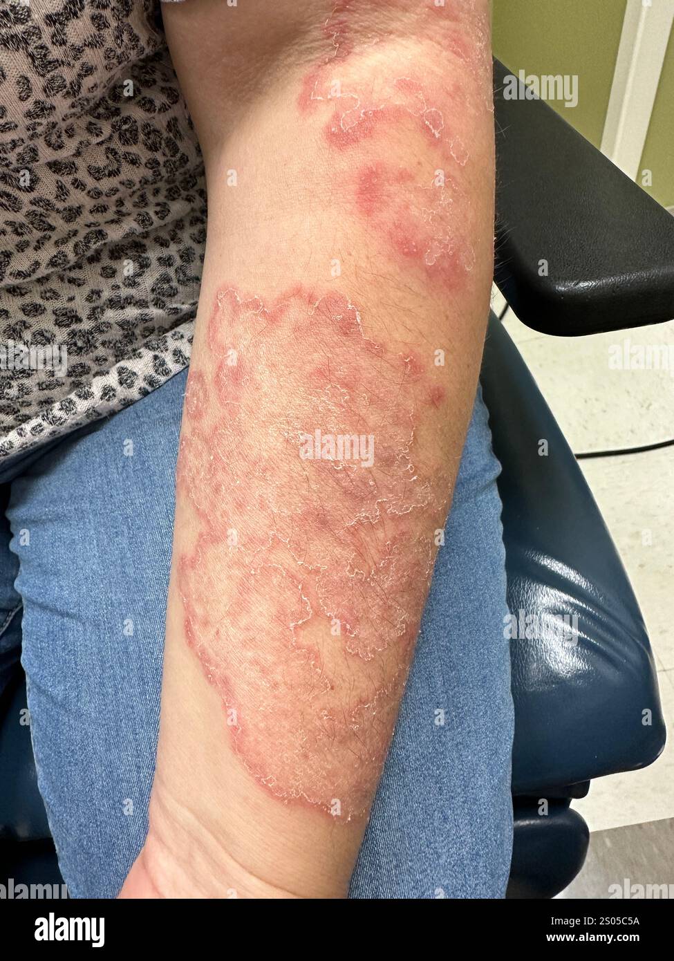 Ringworm infection on a patient's arm. Ringworm is a disease caused by ...