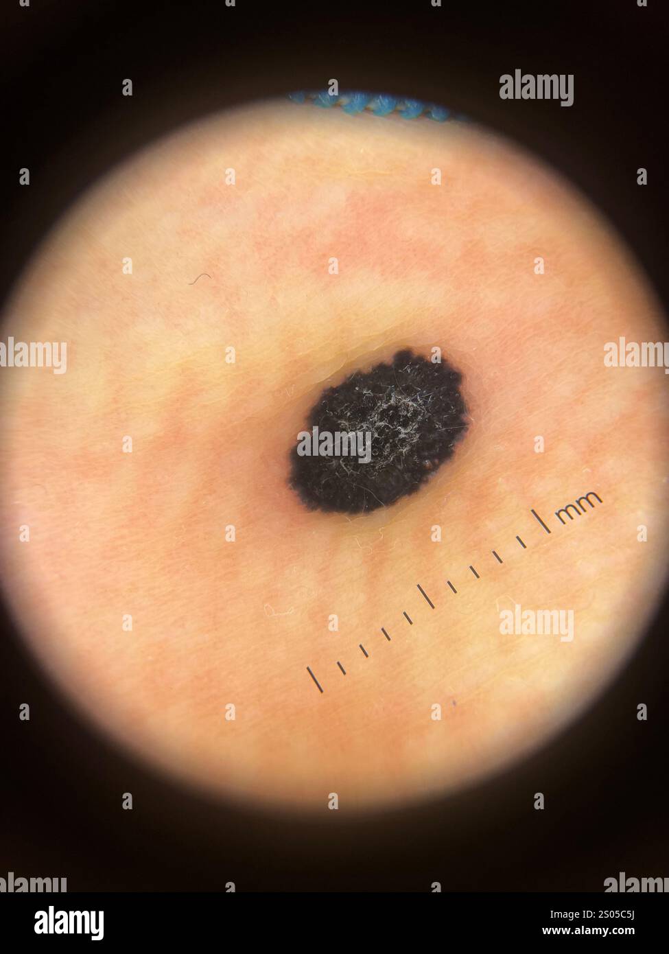 Dermatoscope image of a Reed nevus on a child's skin. This dark star ...