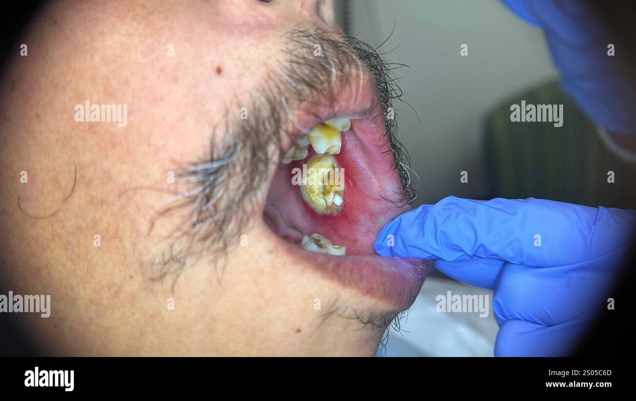 Traumatic ulcerative granuloma with stromal eosinophilia (TUGSE) on the ...