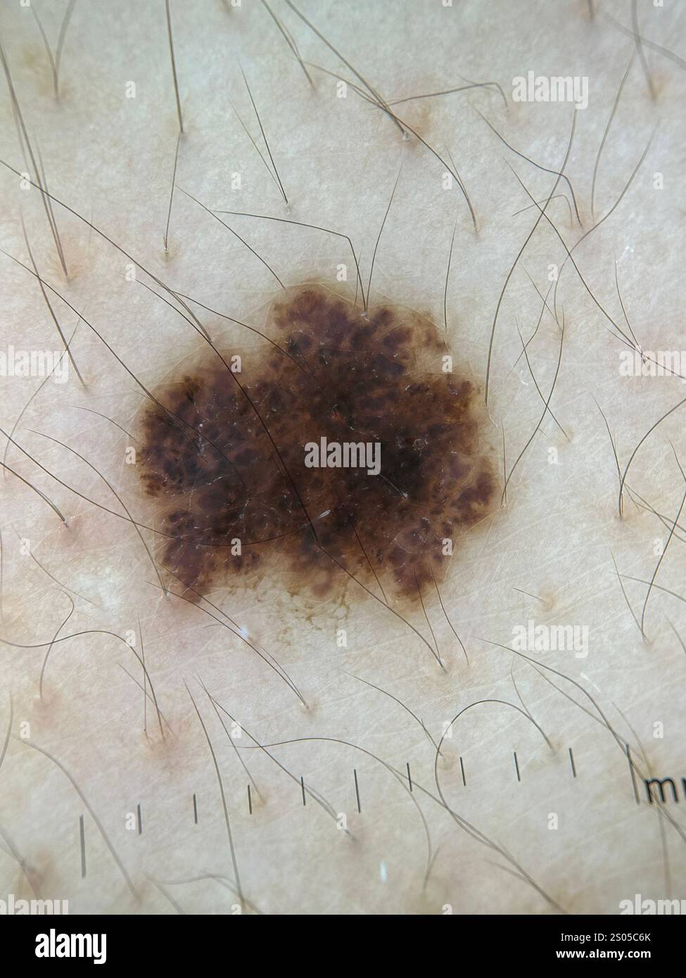 Dermatoscope image of globules (round to oval structures) in a mole on ...