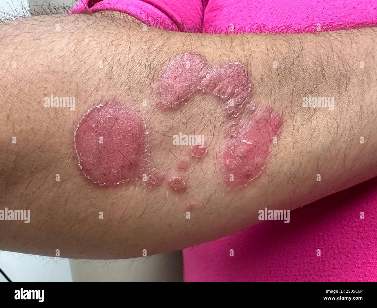 Lesions on the arm of a 42 year old Hispanic female patient with ...