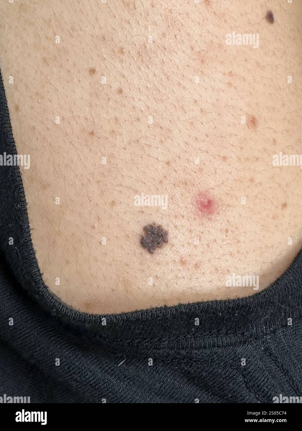 Globules (round to oval structures) in a mole on the skin of a young ...