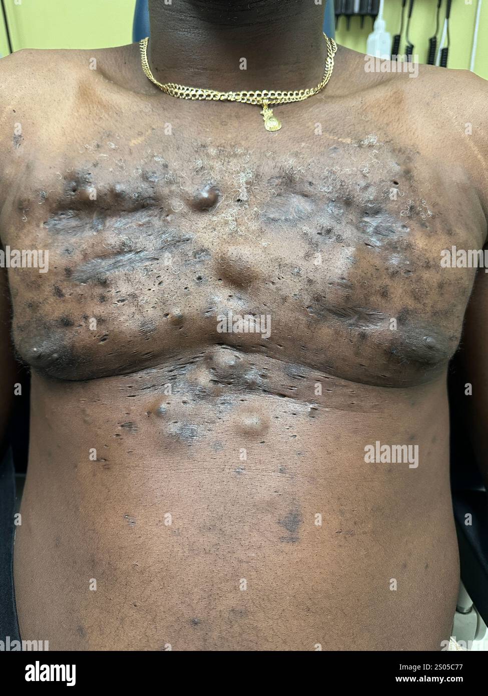 Cysts and scars on the chest of a patient with steatocystoma multiplex ...