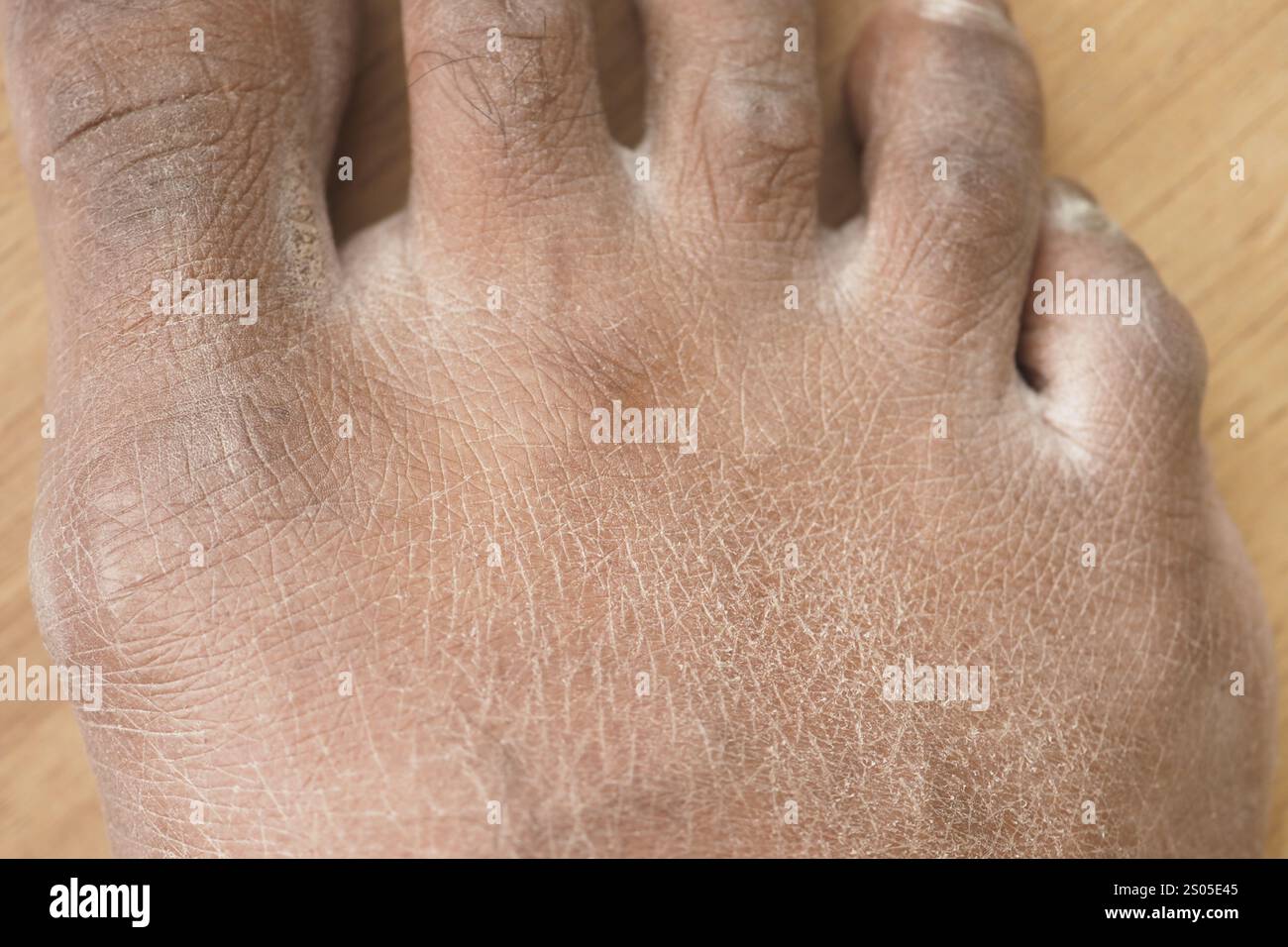 Closeup view of dry human skin Stock Photo - Alamy