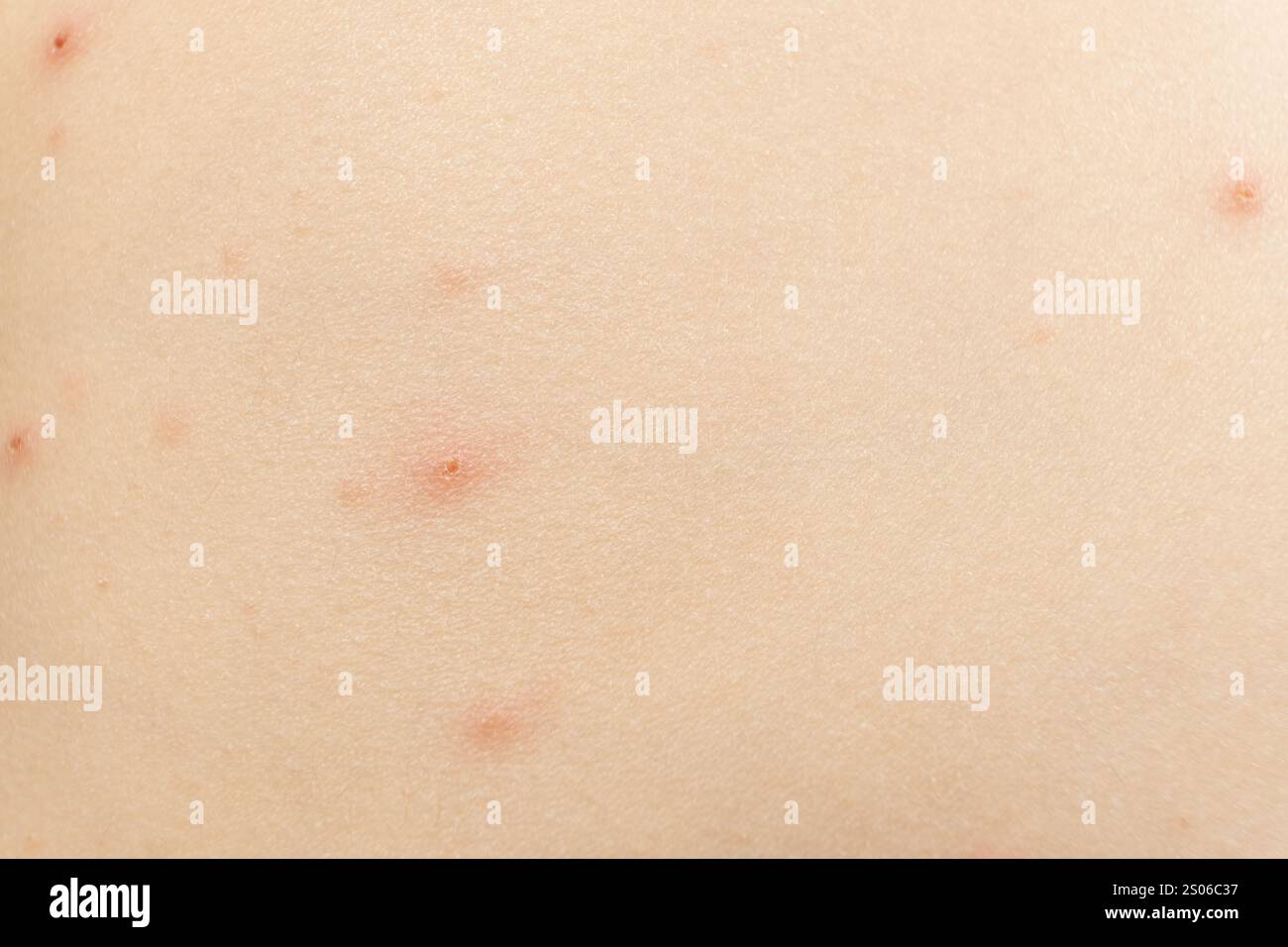 Macro skin with chickenpox, vesicles at different stages Stock Photo ...