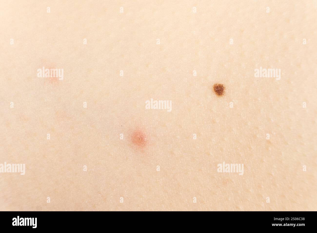 Comparison of chickenpox rashes and nevus on human skin Stock Photo - Alamy