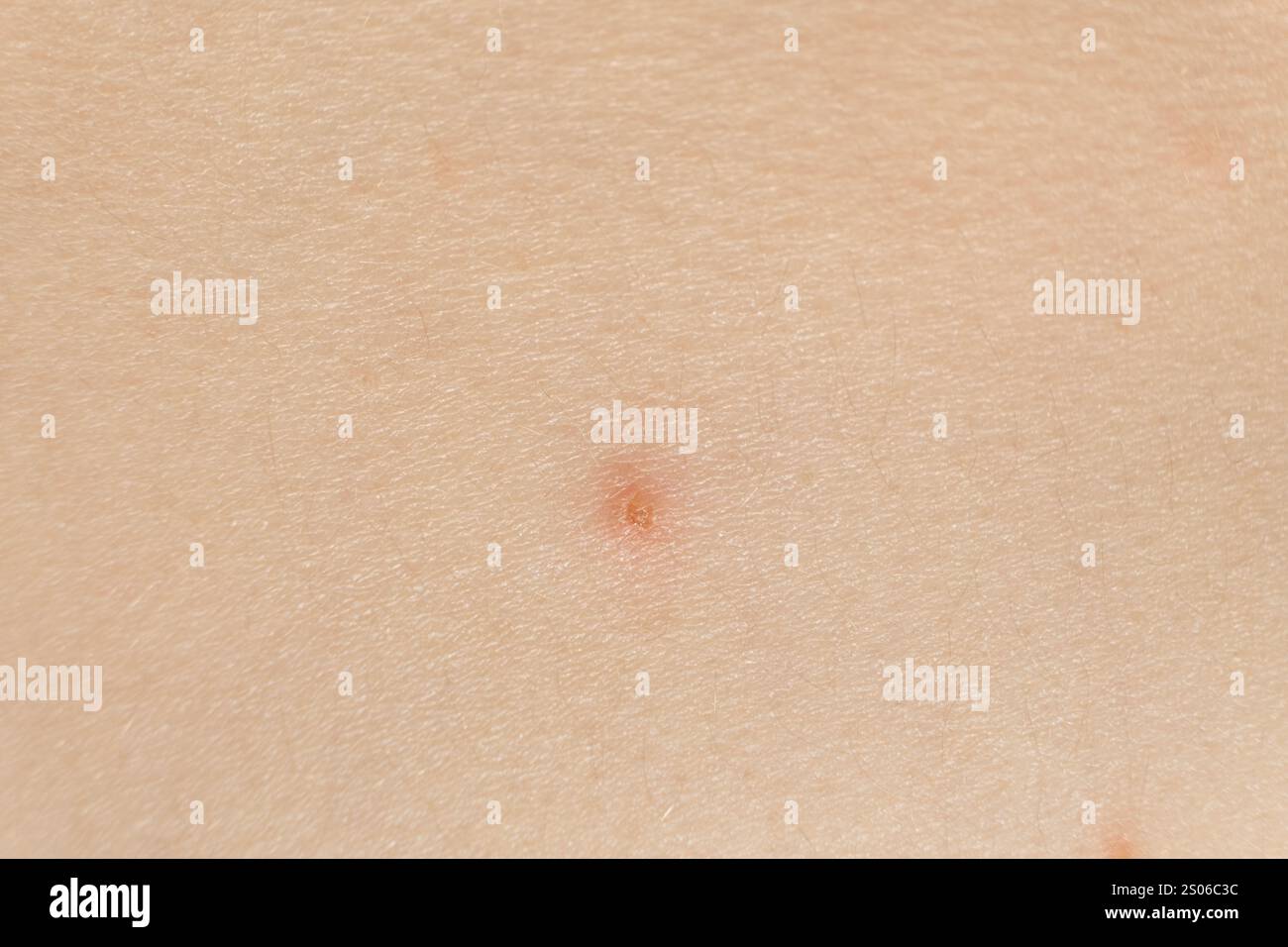 Macro skin with chickenpox, vesicles at different stages Stock Photo ...