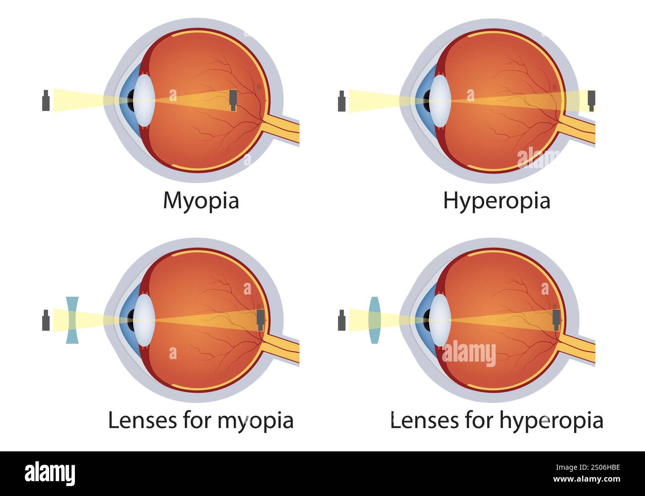 Hyperopia and myopia corrected by lens. Concept of eyes defect ...