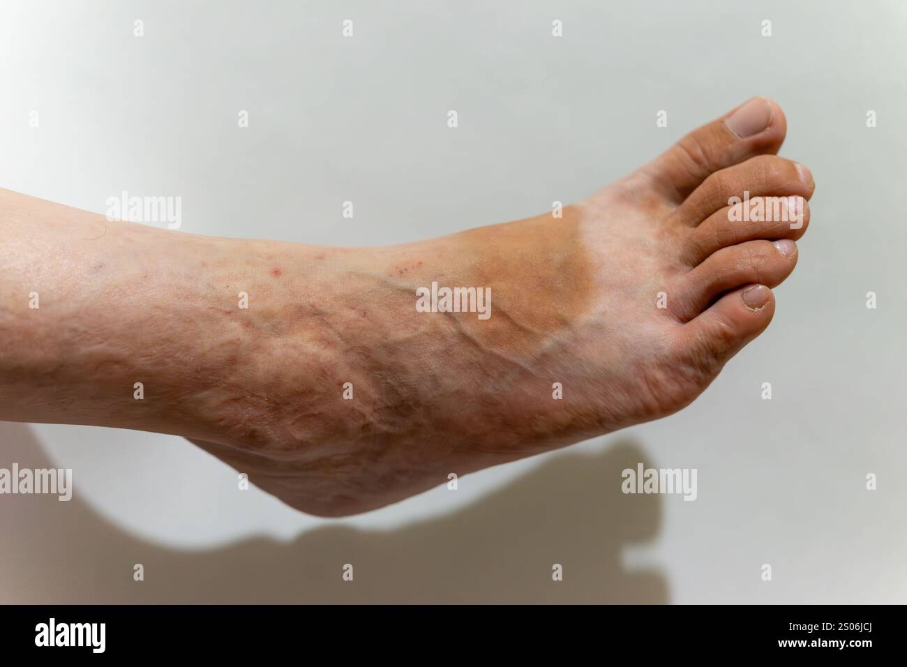 A close-up of a human foot shows veins, skin texture, and natural ...